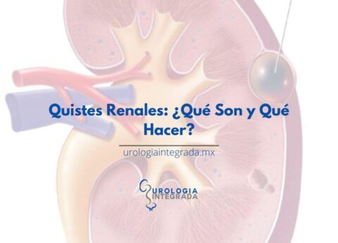 Quistes Renales: ¿Qué Son y Qué Hacer? - Urología Integrada